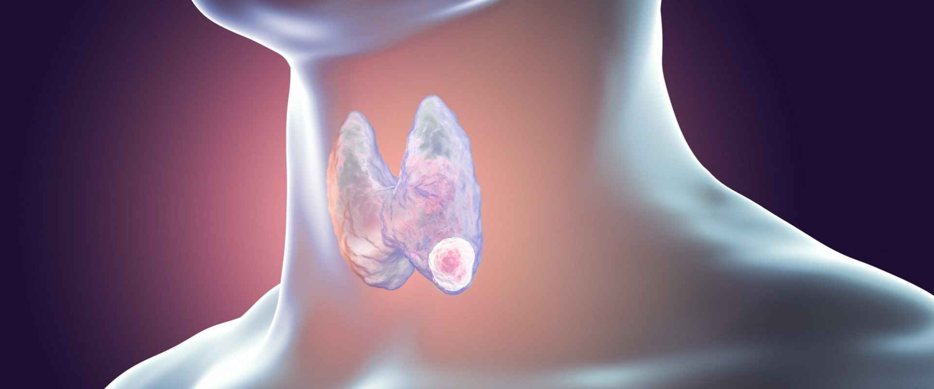 Understanding the 2022 WHO Thyroid Cancer Classification